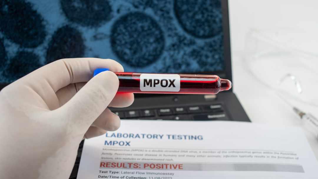 India records first Mpox strain case that prompted WHO public health ...