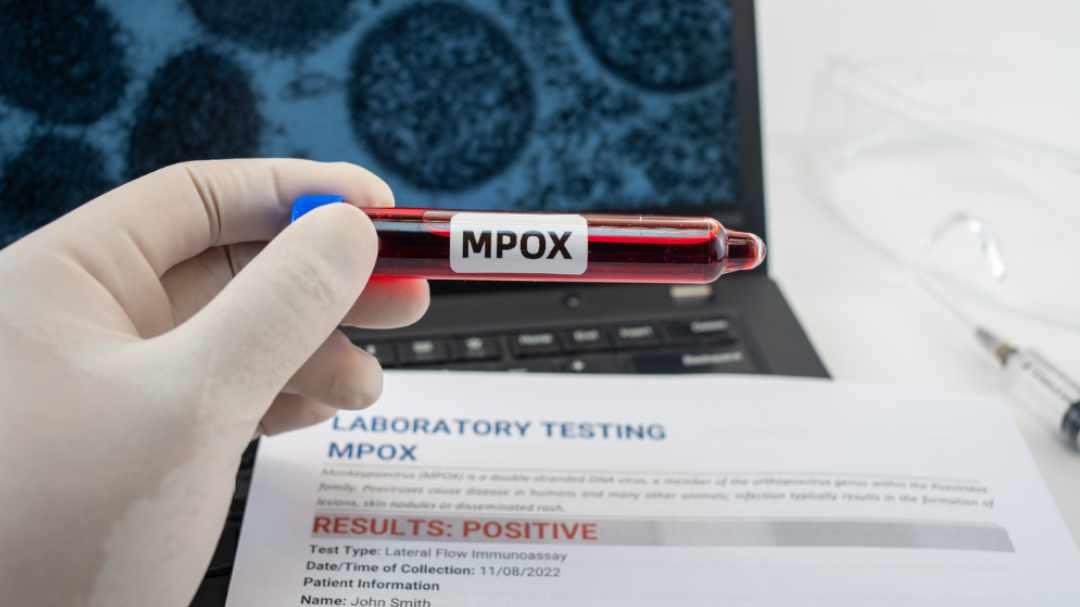 India reports first suspected Mpox case, patient under observation