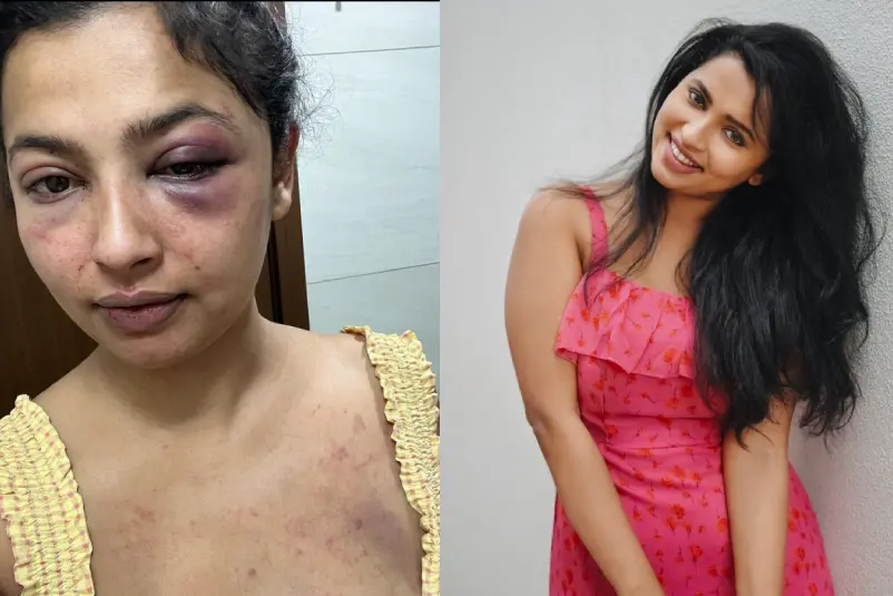 Actor Anicka alleges physical assault by ex-boyfriend, shares pictures ...
