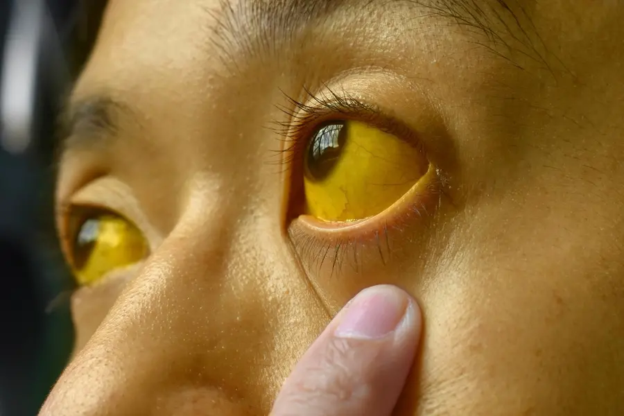 Jaundice cases rise across Kerala; 38 deaths, over 5,400 infections in ...