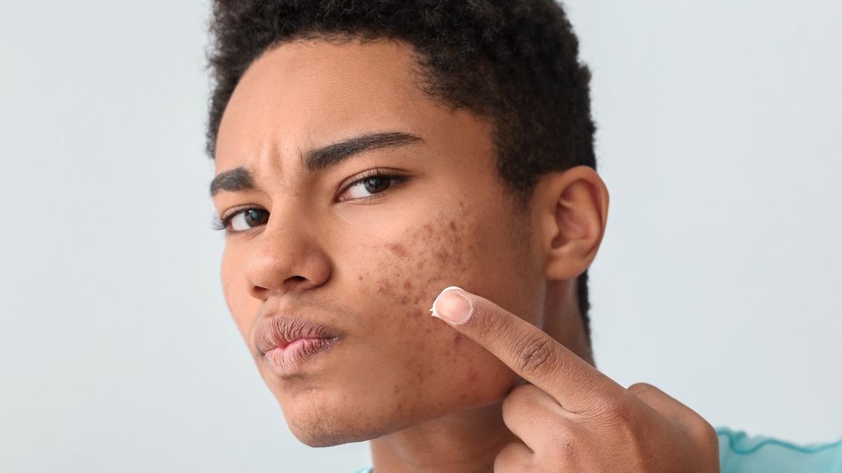 Acne gone, but spots remain? Here’s a skincare strategy that works