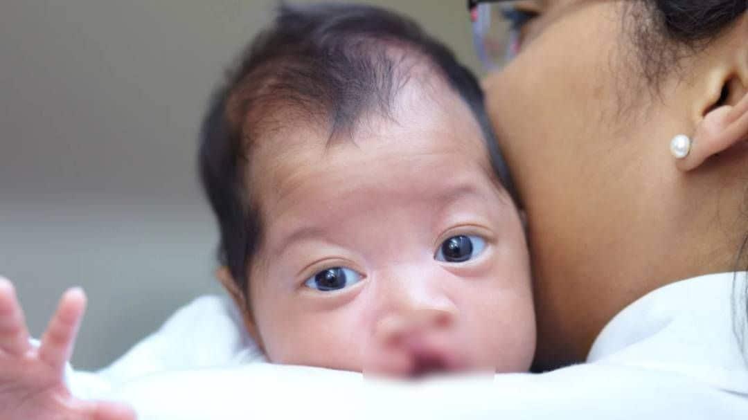 Major Kerala study investigates facial birth defects in children