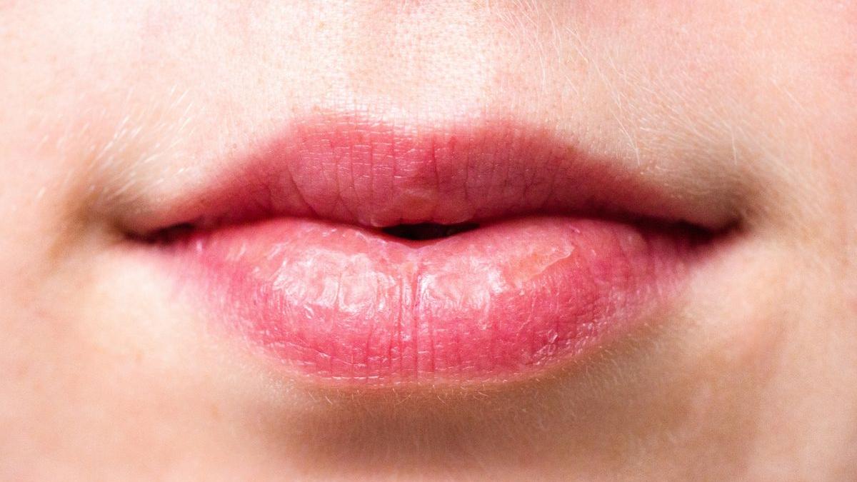 Chapped lips? These kitchen remedies give you soft, pink lips by ...