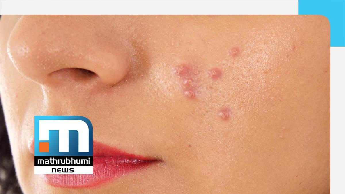 Pimples and treatment - Doctor@2PM | Mathrubhumi TV