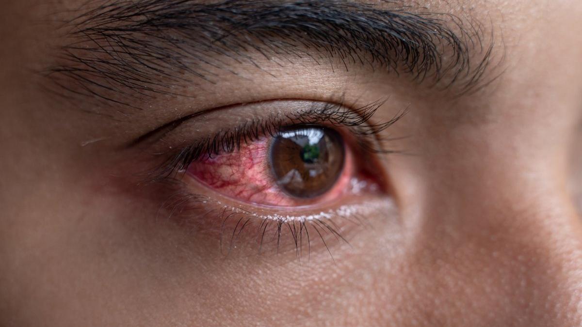 Kerala sees surge in red eye cases; Why recovery takes longer and how ...