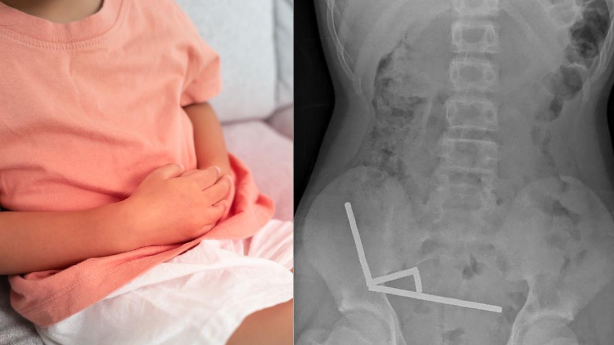 13-year-old boy swallows nearly 100 high-powered magnets, undergoes ...